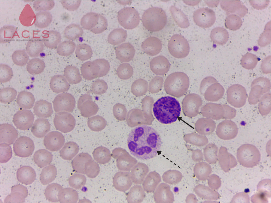 O Que Quer Dizer Segmentados No Exame De Sangue - LIBRAIN